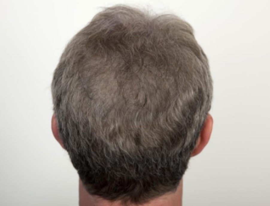 Alan’s Hair Transplant | Case Study | Crown Clinic