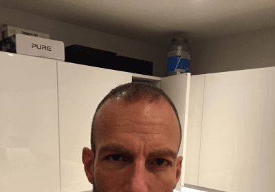 Journalist James Ingham | Hair Transplant Case Study | Crown Clinic