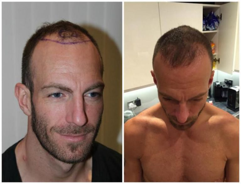 Eyebrow Transplants UK | Book a free Consult | Crown Clinic