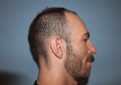 Journalist James Ingham | Hair Transplant Case Study | Crown Clinic