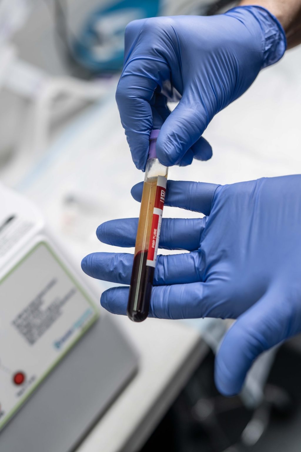 Platelet Rich Plasma (PRP) Therapy | Crown Clinic